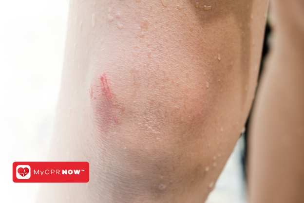 what to do with a stab wound