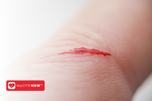 Post-Bleeding Care: Preventing Infections in Wounds